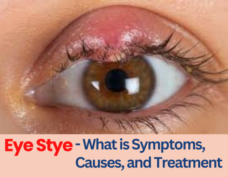 Eye Stye - What is Symptoms, Causes, and Treatment - Iris Eye Care